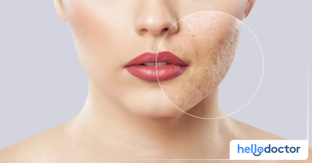 The Best Acne Prevention and Treatment Tips - Hello Doctor