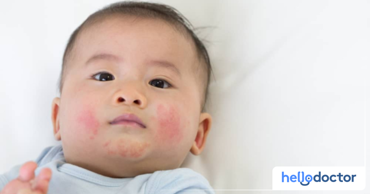 Common Baby Skin Rashes You Can Treat at Home - Hello Doctor