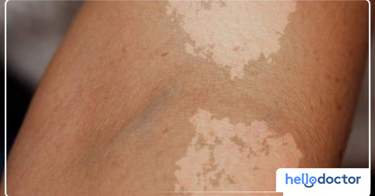 An-An Treatment: How to Manage Tinea Versicolor
