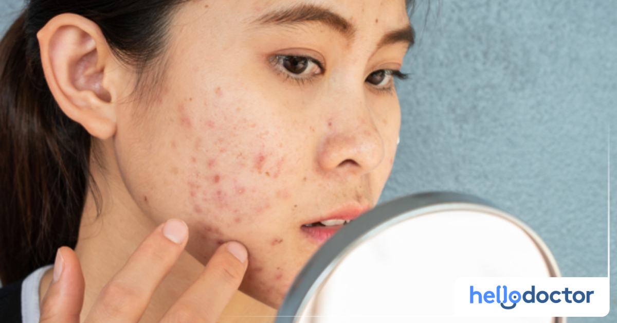 How to Manage teenage Acne: Expert-Approved Tips to Beat Breakouts