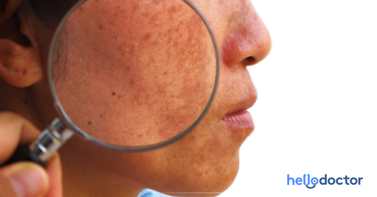 Melasma vs Hyperpigmentation: What's the Difference?
