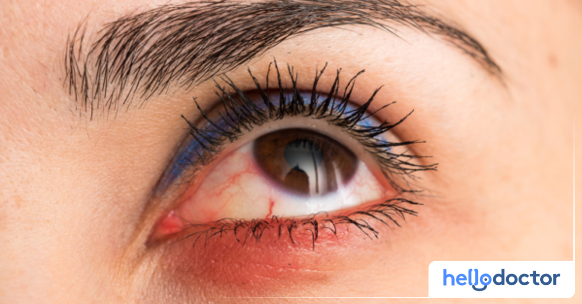 Uveitis Treatment and Diagnosis: What You Should Know