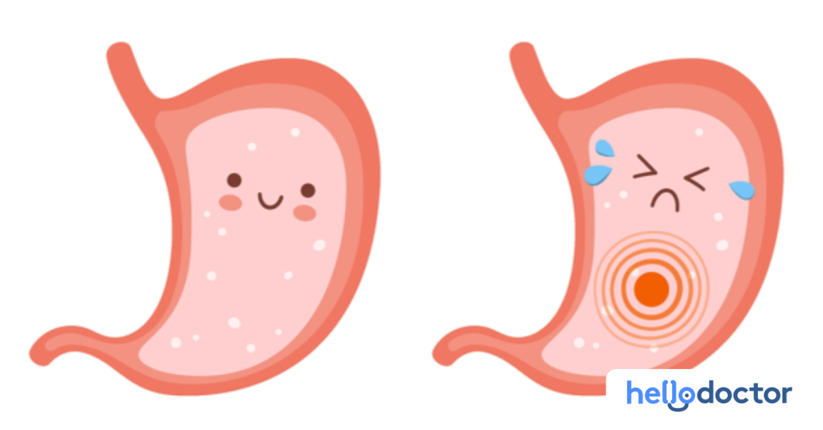 What Causes Ulcers in Children? Plus Home Remedies for Peptic Ulcer