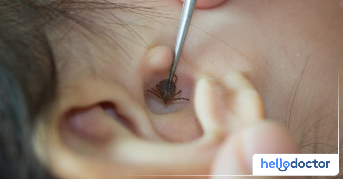 Insect in Ear Removal: How to Do it Safely and Effectively