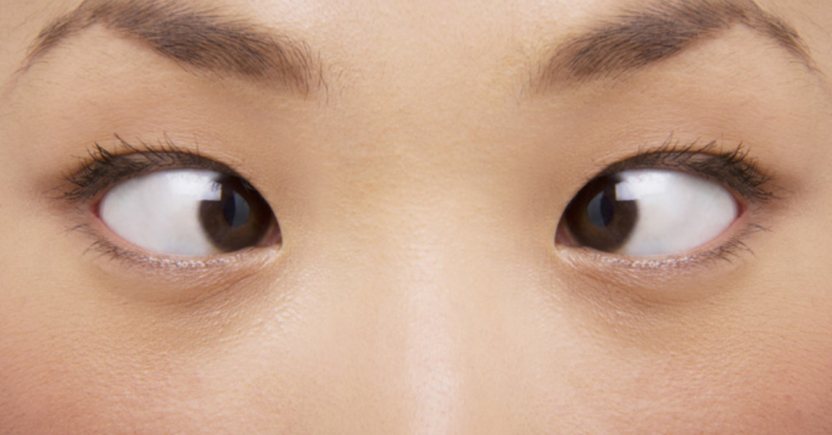Banlag na Mata at Duling na Mata: What is Strabismus?