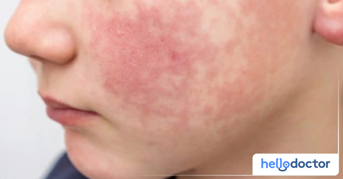 Slapped Cheek Syndrome: Important Facts about This Viral Infection