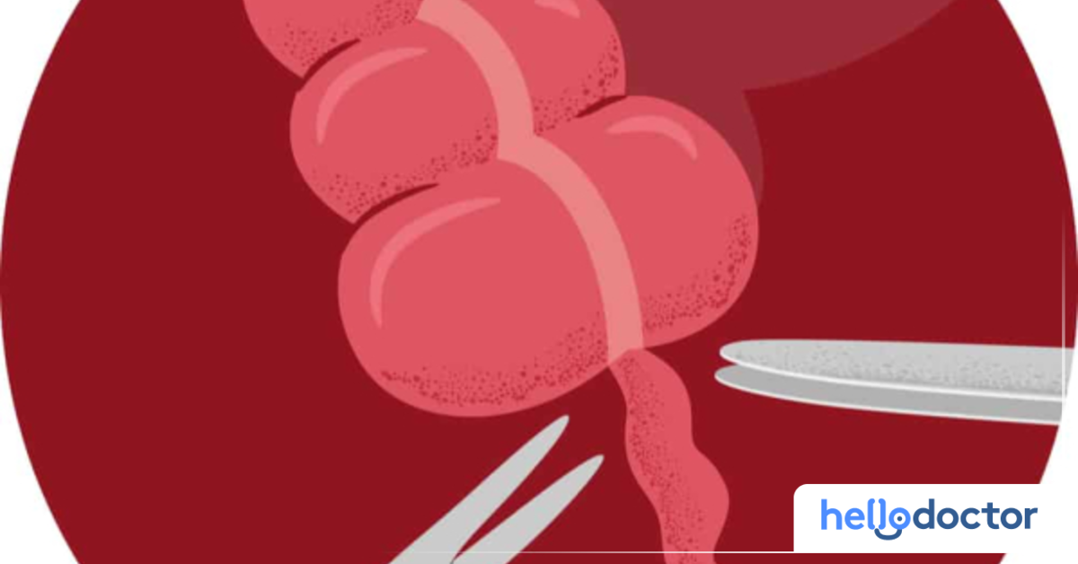 Appendectomy: What is it and How is the Procedure Done?