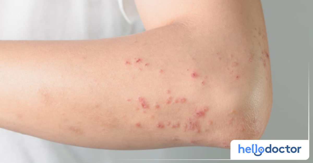 Hives Treatment: Here's What You Can Do About Hives
