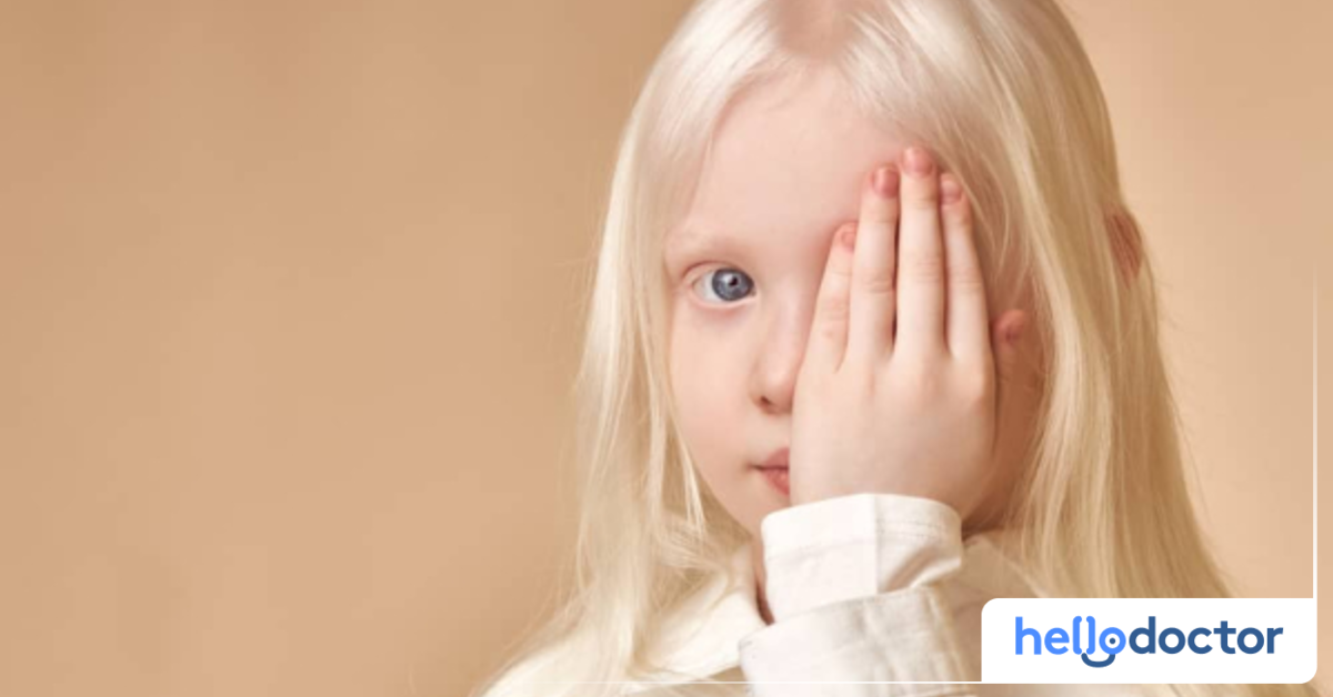 Albinism and Albinism Treatment: What You Need To Know