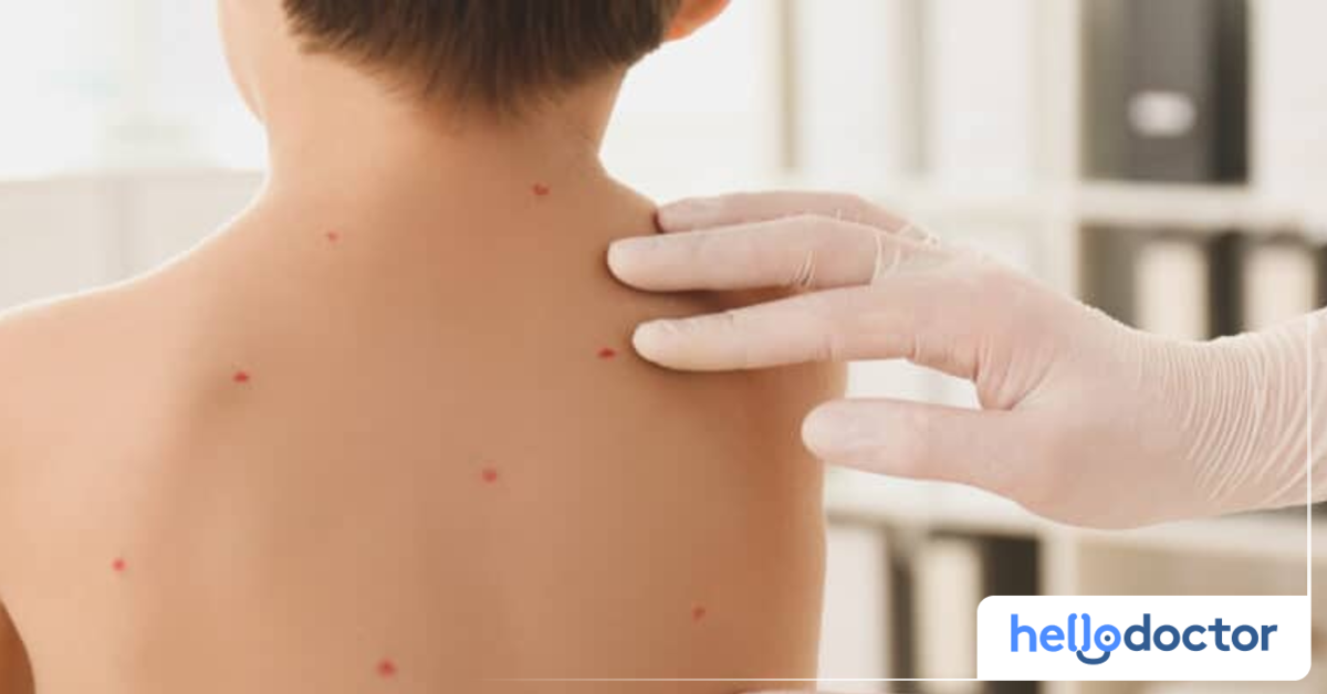 Bulutong Ba Yan? What To Do When You See Chickenpox Rash