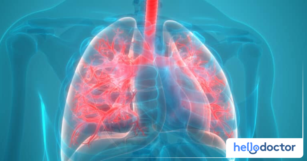 What are the 4 Stages of Pneumonia? Find Out Here