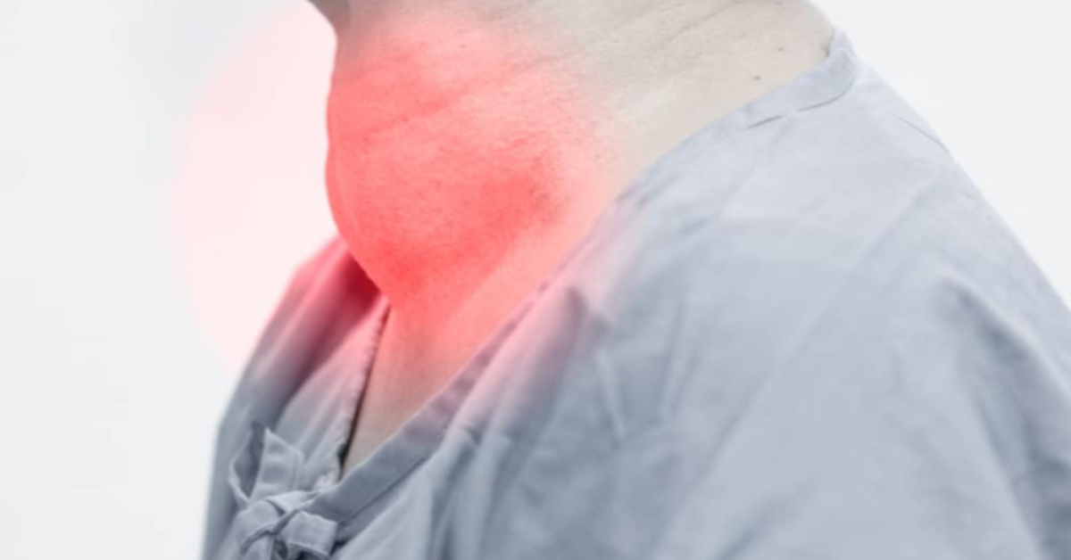 What Is Goiter? And What Are Goiter Symptoms to Watch Out For?