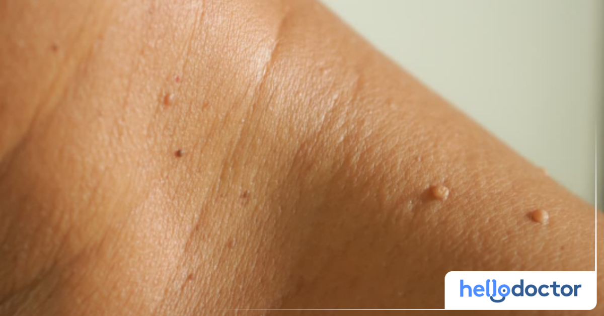 Skin Tags: Causes, Symptoms, Treatment, and Home Remedies