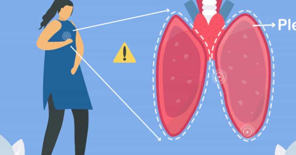 Pleurisy: What To Know About Its Causes, Symptoms, Treatment