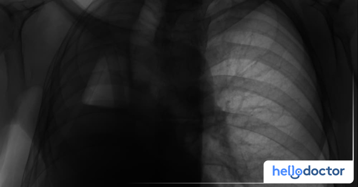 Lung Removal or Pneumonectomy: Can You Live With Only One Lung?