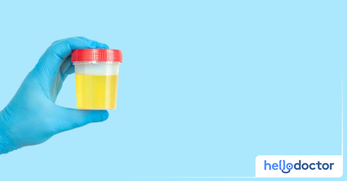 Urinalysis (Urine Test): Why and How is it Done?