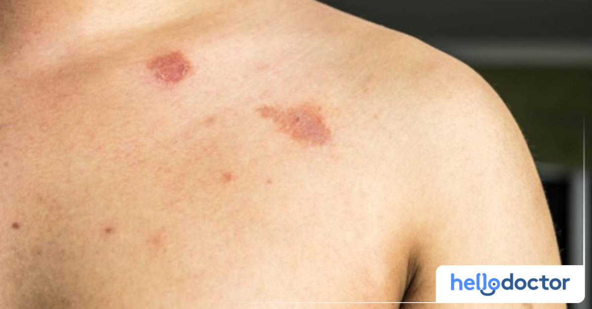 Buni Treatment: Ano Ang Mainam Na Gamot Sa Buni?