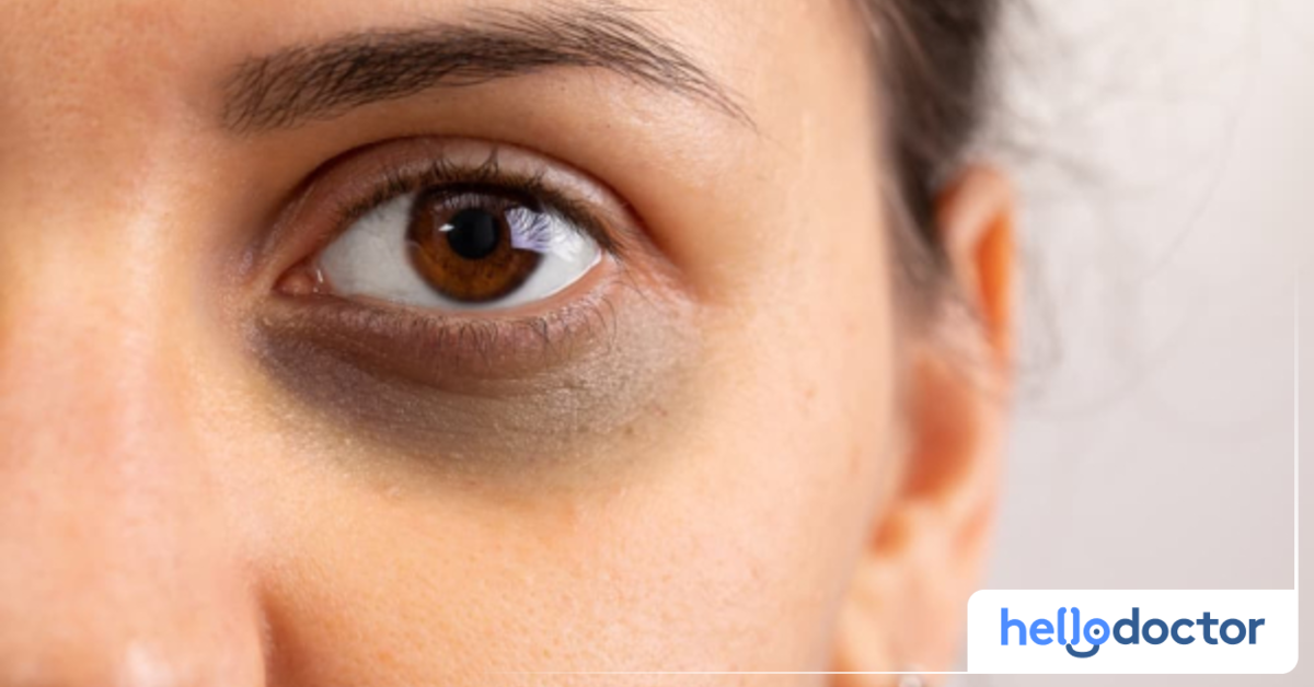 Black Eye: Causes, Treatment, & Complications