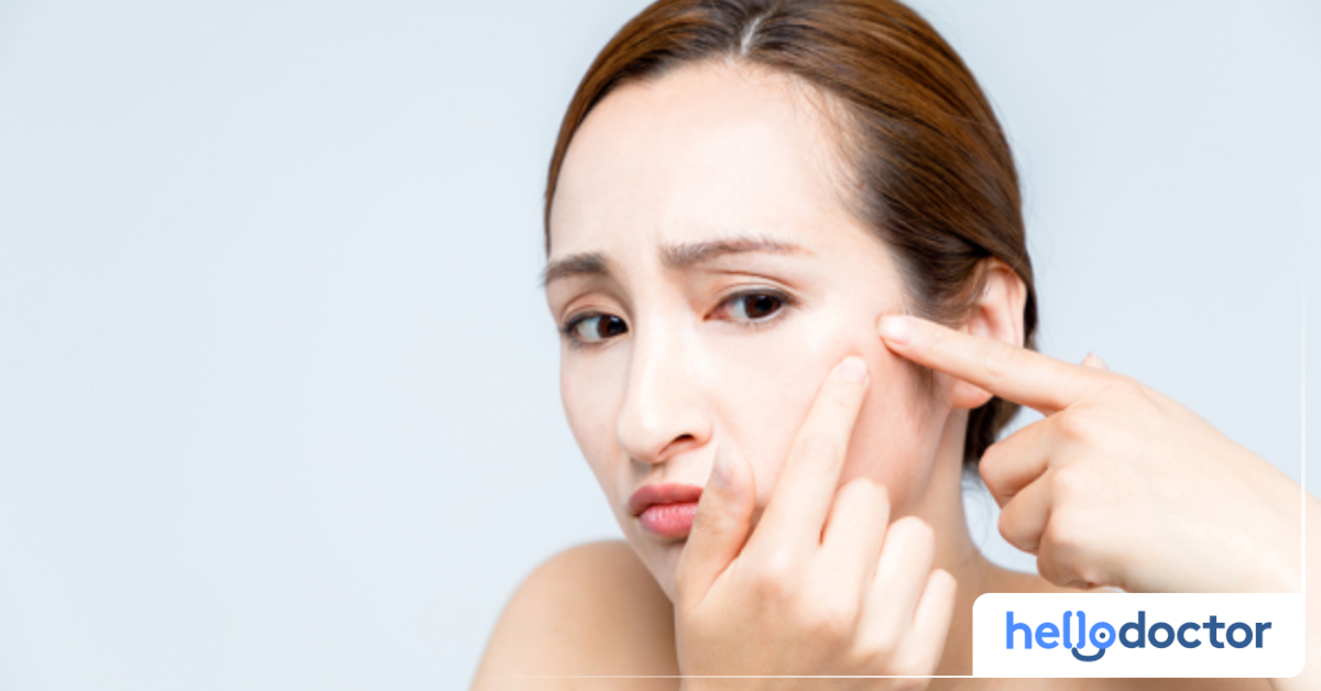 How to Cure Boils at Home: 5 Things You Need to Remember