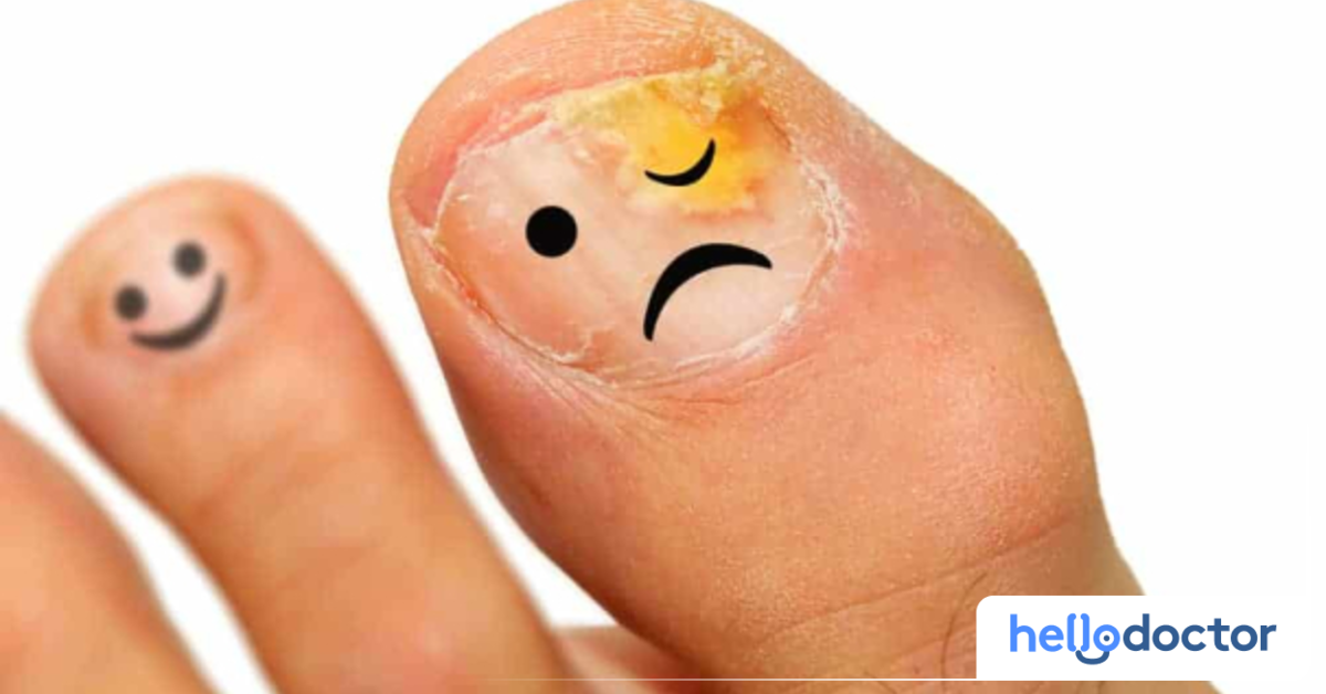 Fungus sa Kuko: Bakit ito Tumutbo at Paano ito Gamutin?