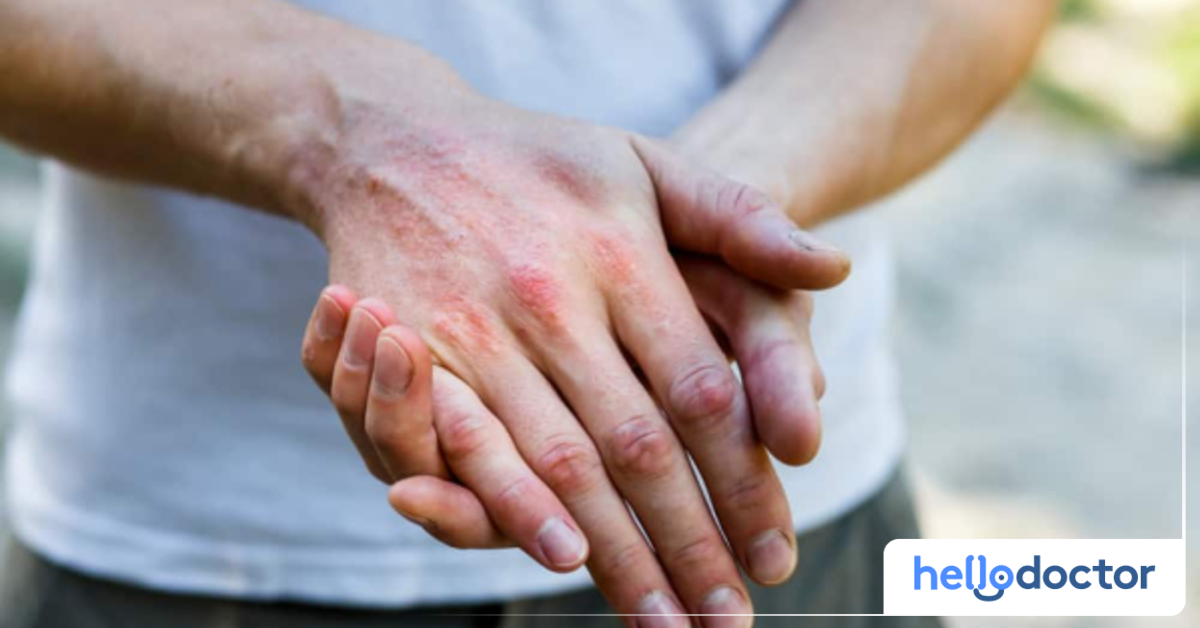 Ano ang Atopic Dermatitis at Paano Ito Nagagamot?
