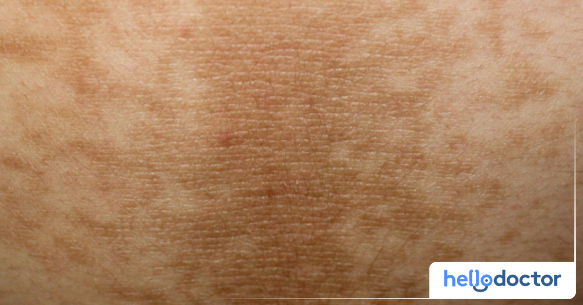 A Closer Look at Different Diabetic Rash Types and Other Skin Conditions