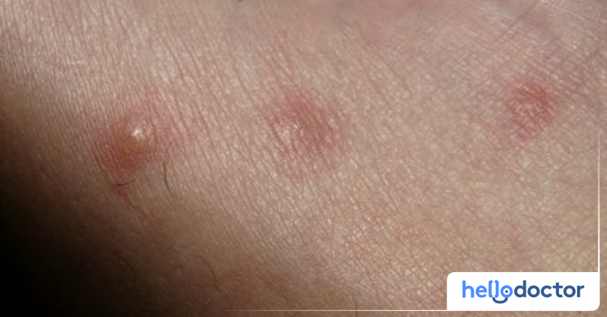 Diabetic Bullae (Blisters): Causes, Treatment, And Prevention