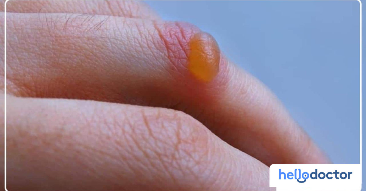 Butlig na May Tubig, Ano ang Maaaring Sanhi Nito?