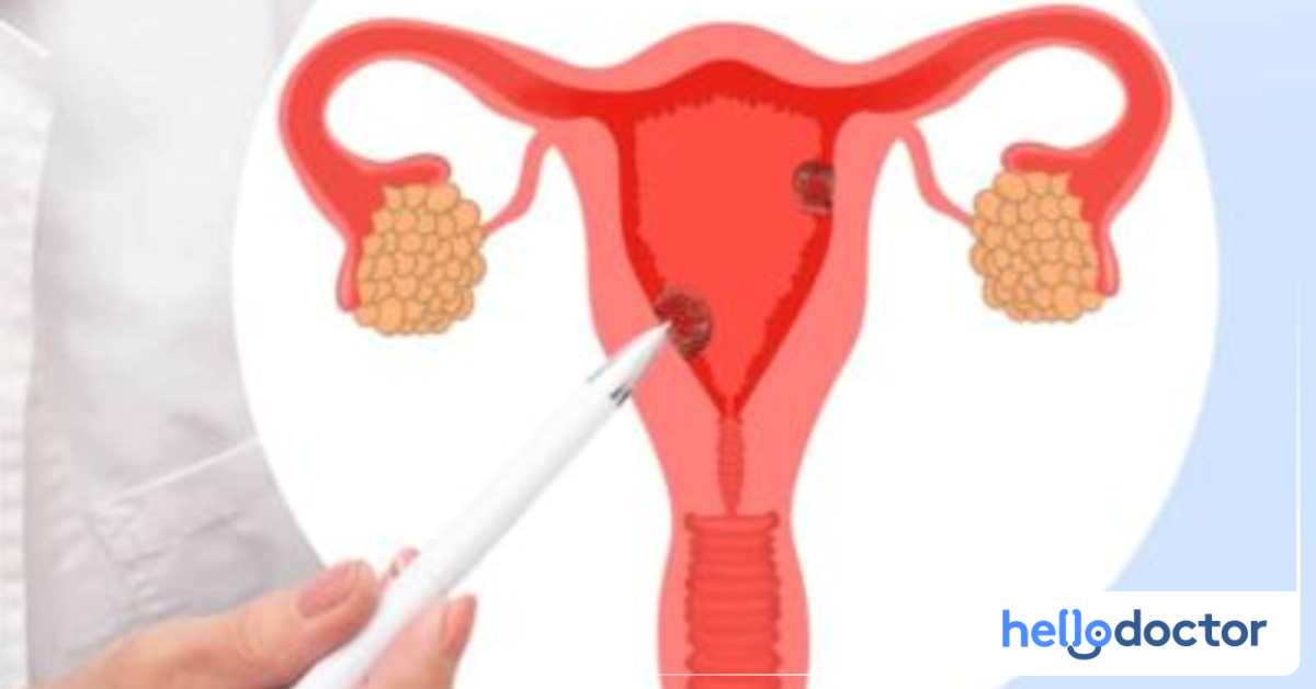 Pagtanggal Ng Polyps Sa Uterus, Paano Ba Ito Isinasagawa?