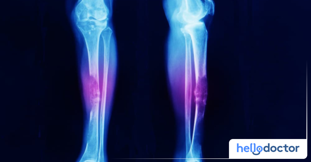 What Happens To Cancer That Spreads To The Bones?