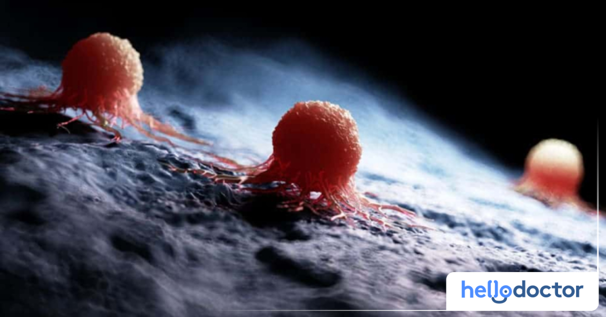 Pinagkaiba ng benign at malignant tumor, ano nga ba?