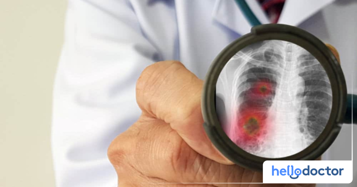 Pulmonya Sa Pilipinas: Dapat Bang Ipag-Alala Ang Sakit Na Ito?