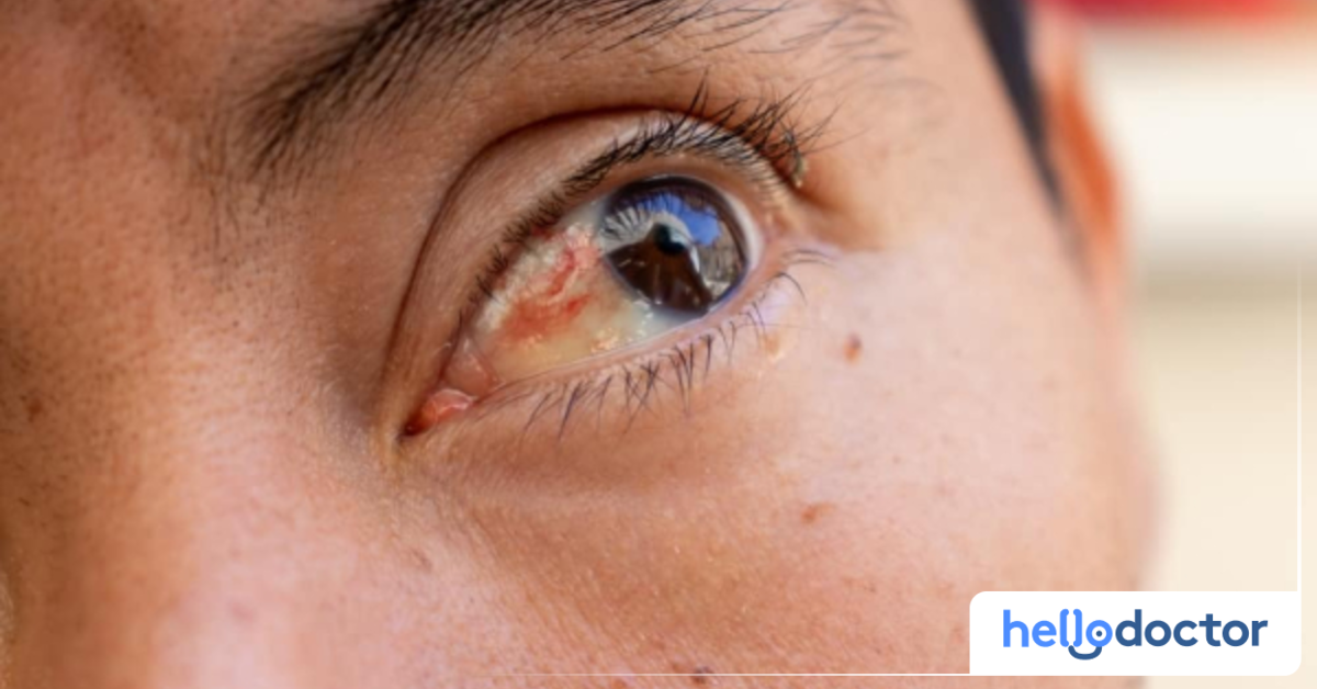 Dapat bang Mag-alala sa Namuong Dugo sa Mata?