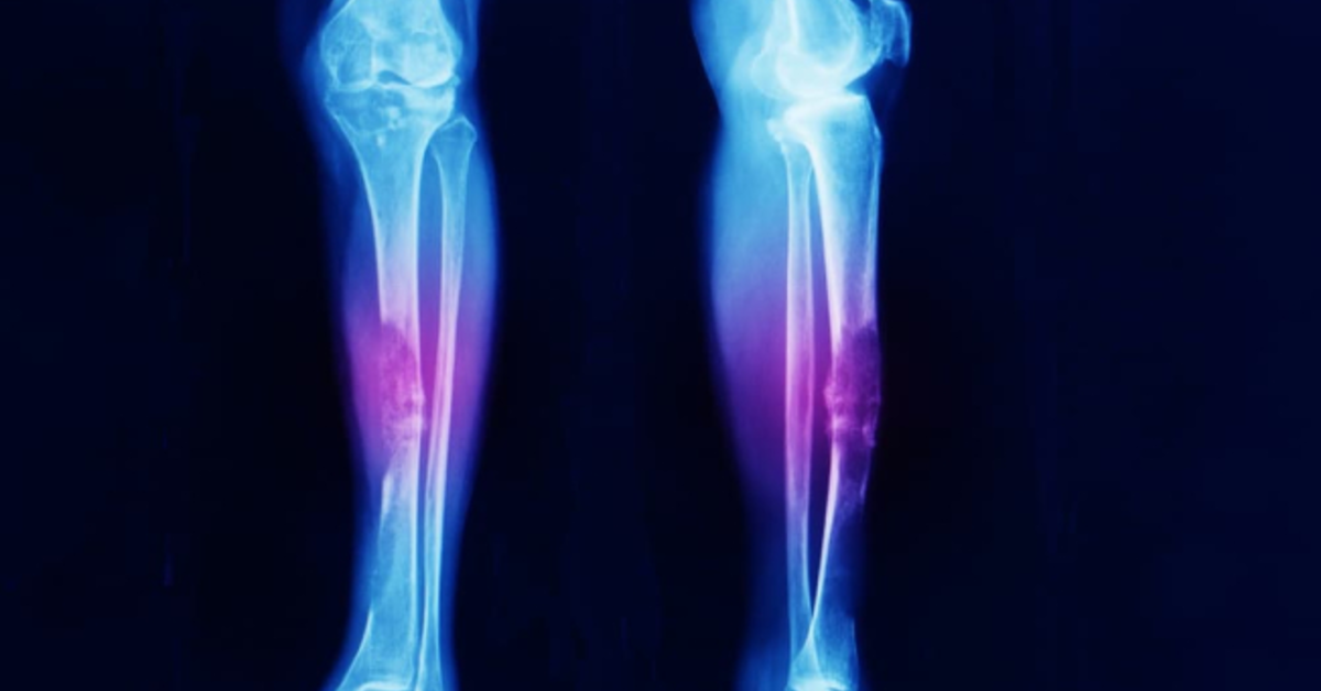 Alamin: Mga sintomas ng cancer sa buto