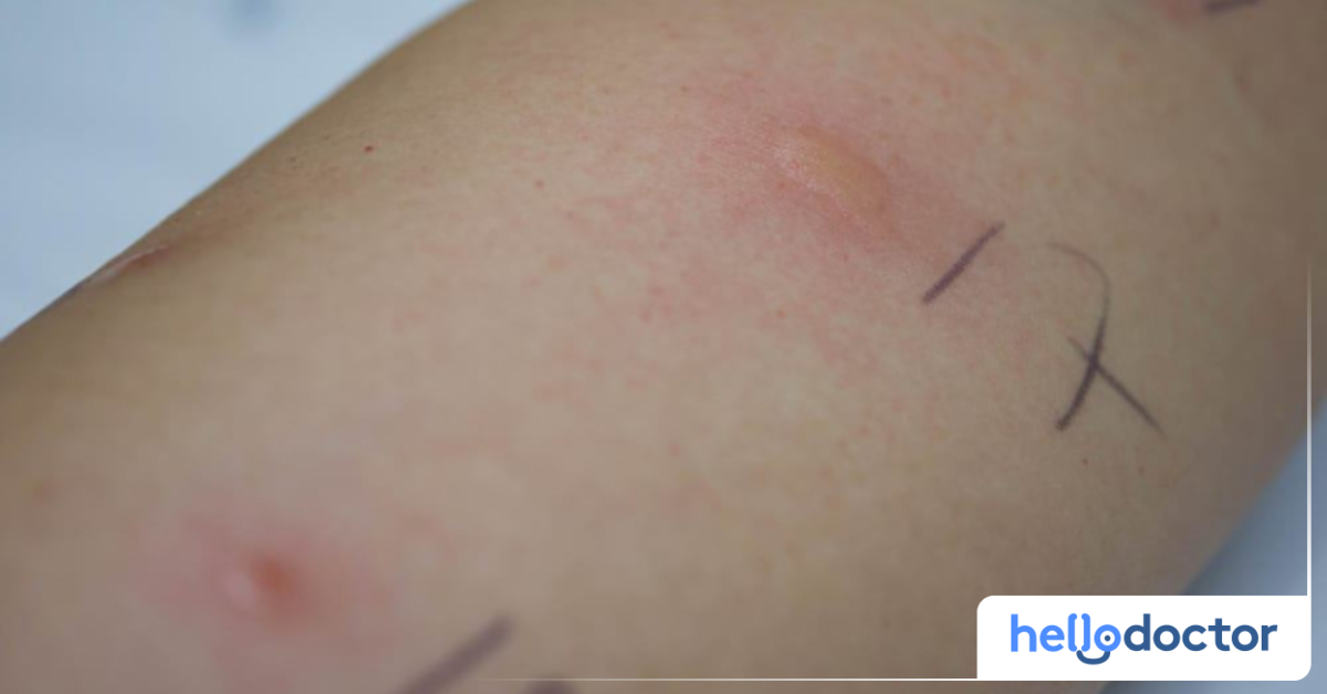 Alamin: Mga skin test para sa allergy