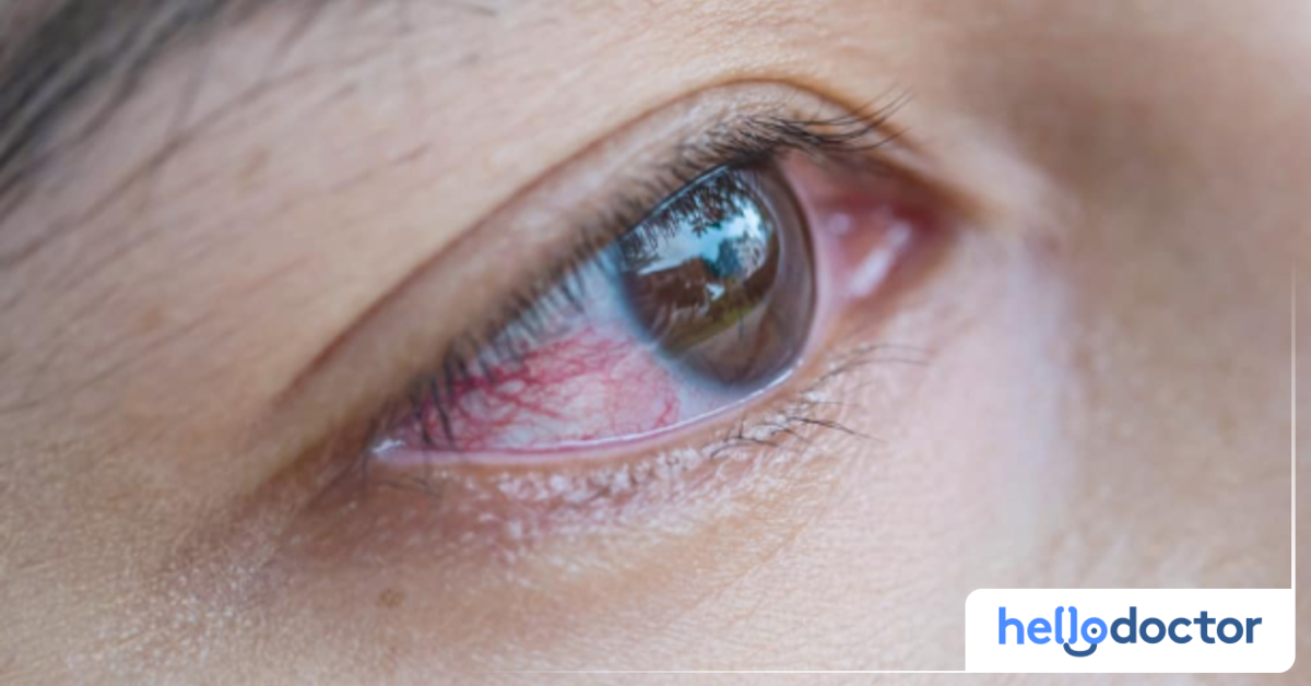 Paano Maiiwasan Ang Pamumula Ng Mata? Heto Ang Dapat Mong Gawin