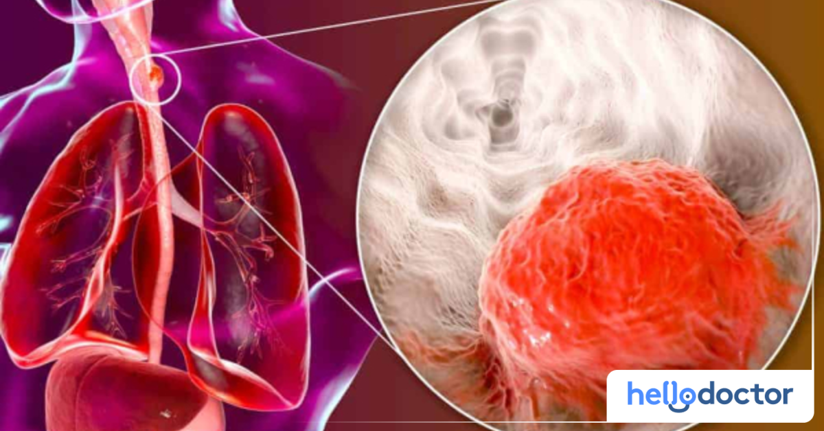 Kaalaman Sa Esophageal Cancer: Mga Senyales At Sintomas